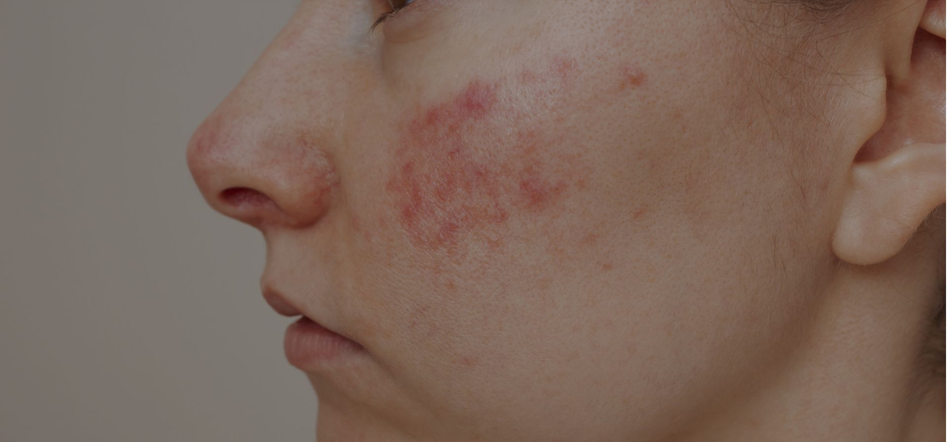 Facial Redness Treatments in Melbourne | Kew Dermatology